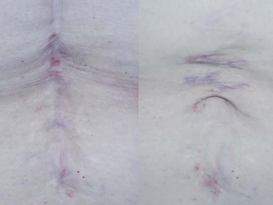 Umbilical Reconstruction - Sadove Cosmetic Surgery